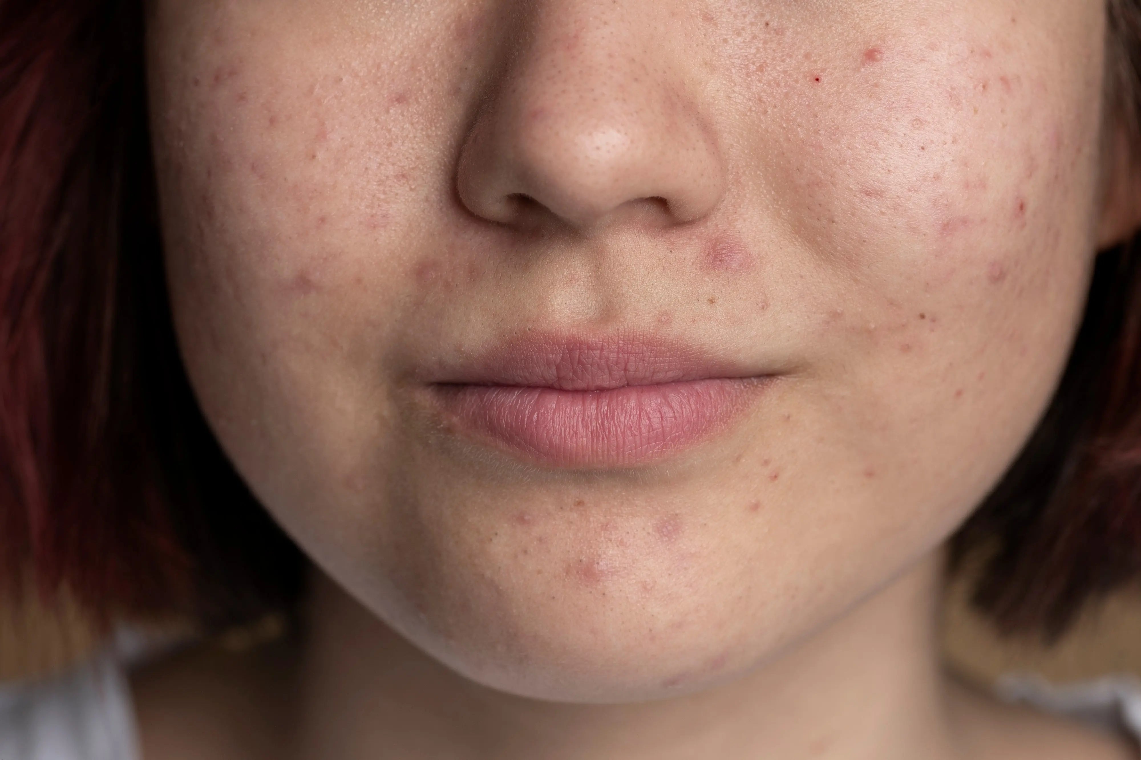 Does Eating Eggs Cause Pimples? What Science Says About Eggs and Acne ...